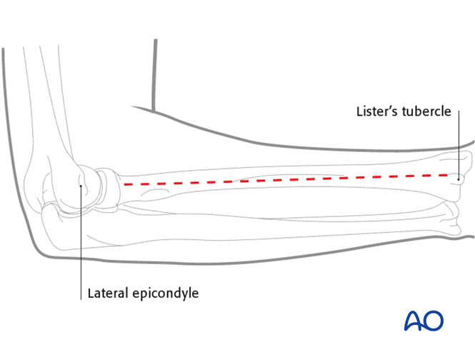Posterolateral approach (Thompson) to the forearm shaft