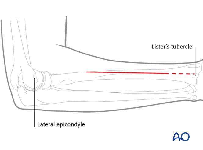 Posterolateral approach (Thompson) to the forearm shaft