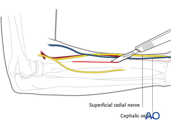 Posterolateral approach (Thompson) to the forearm shaft