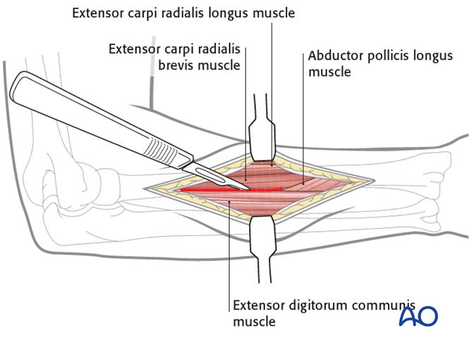 Posterolateral approach (Thompson) to the forearm shaft