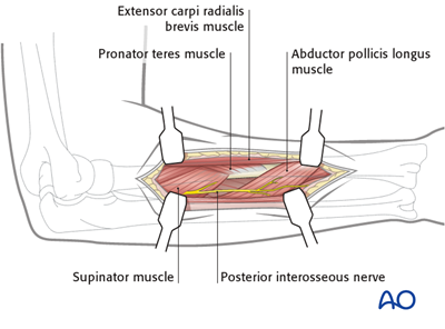Posterolateral approach (Thompson) to the forearm shaft