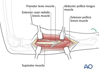 Posterolateral approach (Thompson) to the forearm shaft