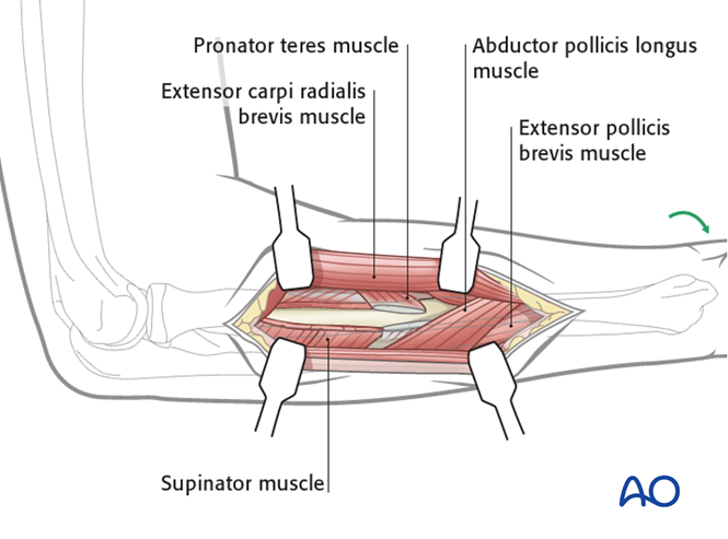 Dorsal Thompson Approach _ Comparison of Dorsal and Volar Approaches to ...