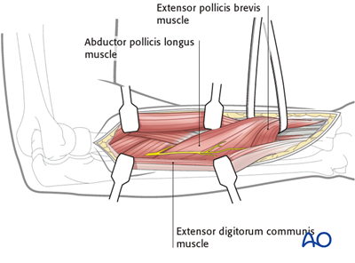 Posterolateral approach (Thompson) to the forearm shaft