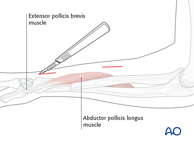 Posterolateral approach (Thompson) to the forearm shaft