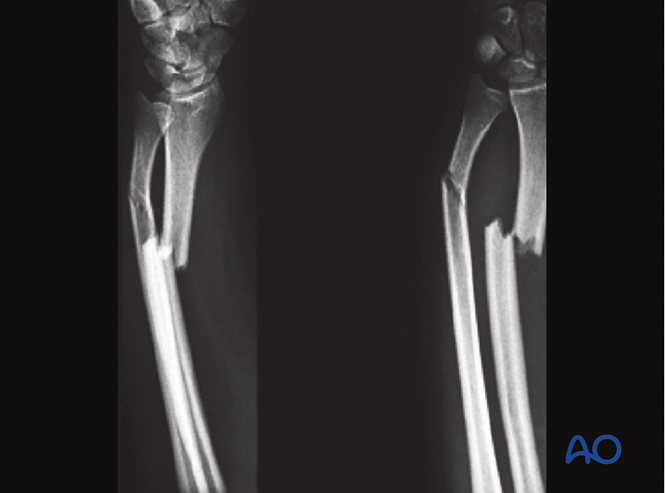 Simple fracture of the radius and the ulna