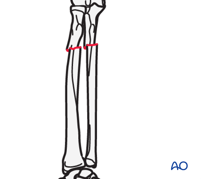 Simple fracture of the radius and the ulna