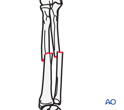 Simple fracture of the radius and the ulna