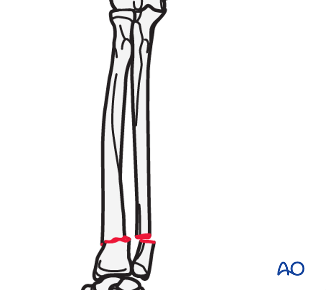 Simple fracture of the radius and the ulna