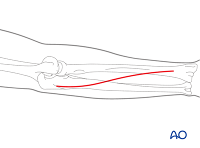 Combined posterior approach to radius and ulna