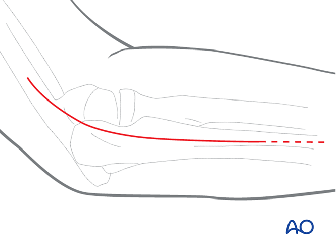 Speed and Boyd’s approach to the forearm shaft