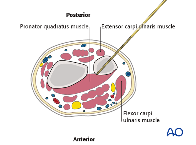 Safe zonesin the forearm for pin placement