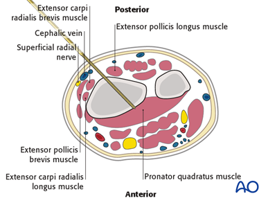 External fixation for Simple fracture of the radius and the ulna
