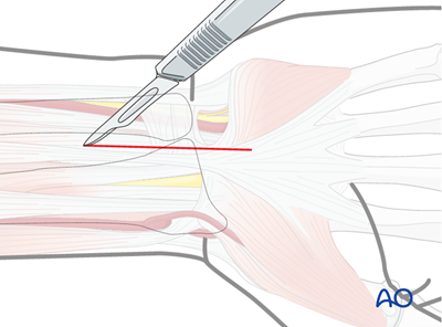 ORIF - Plating for Simple fracture of the radius, with dislocation of ...