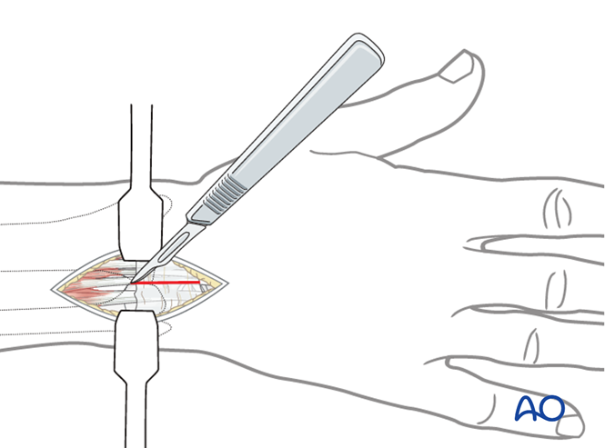 ORIF - Plating for Simple fracture of the radius, with dislocation of ...