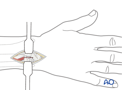 ORIF - Plating for Simple fracture of the radius, with dislocation of ...
