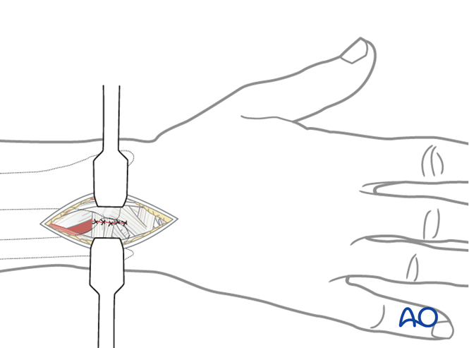 ORIF - Plating for Simple fracture of the radius, with dislocation of ...