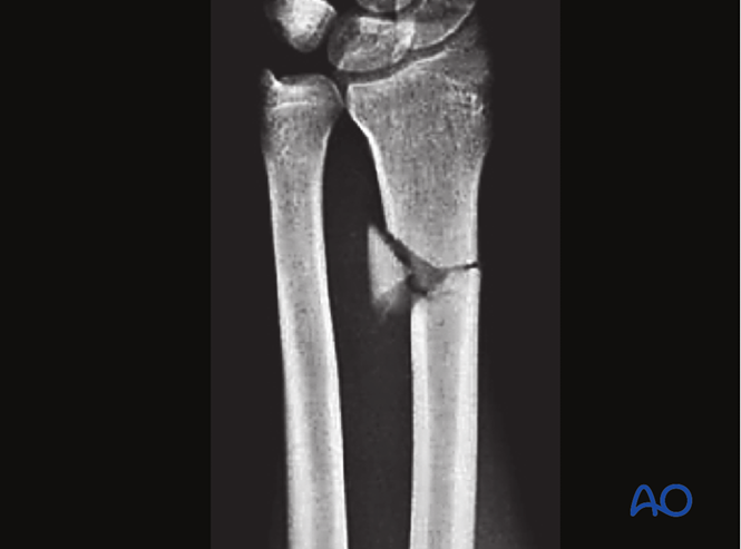 Wedge fracture of the radius with no dislocation