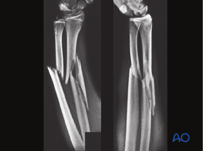 Wedge fracture of one bone, with a simple or wedge fracture of the other