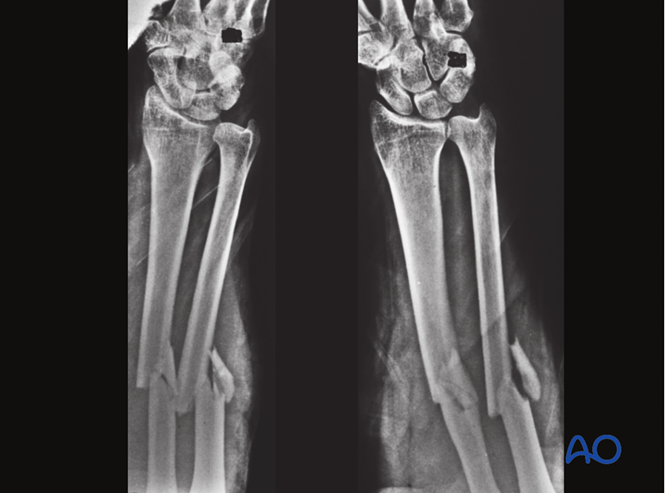 Wedge fracture of one bone, with a simple or wedge fracture of the other