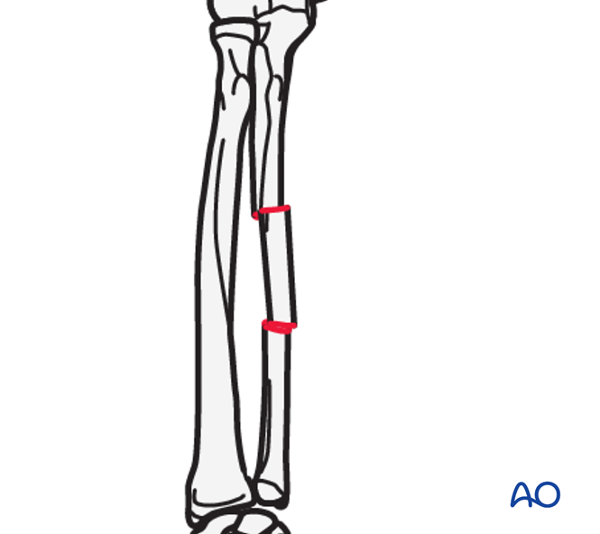 Multifragmentary ulnar fracture with non-multifragmentary radial fracture