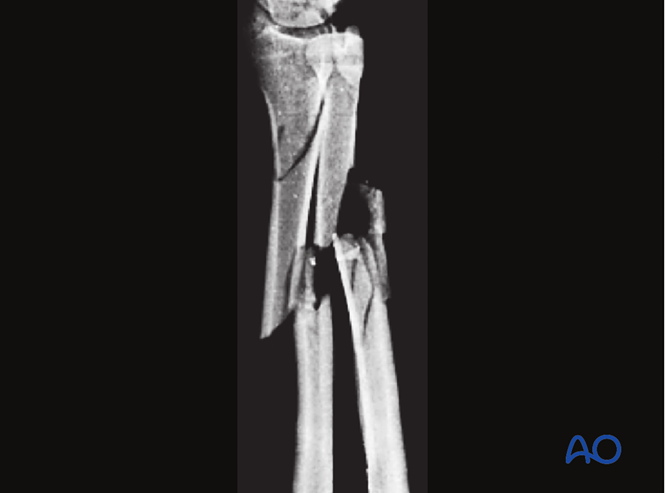 Multifragmentary, fragmentary segmental fracture of both bones