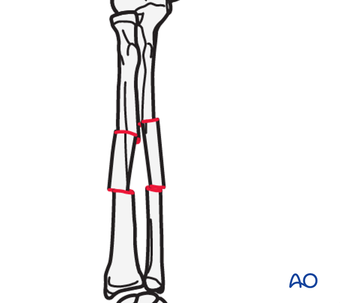 Multifragmentary, intact segmental fracture of both bones