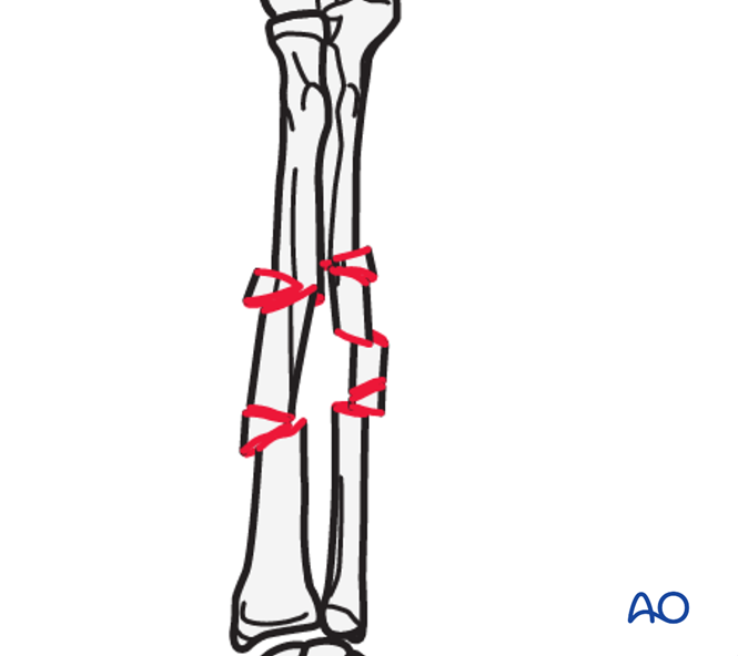 Multifragmentary, fragmentary segmental fracture of both bones