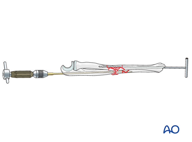 Intramedullary nailing for Multifragmentary, fragmentary segmental ...