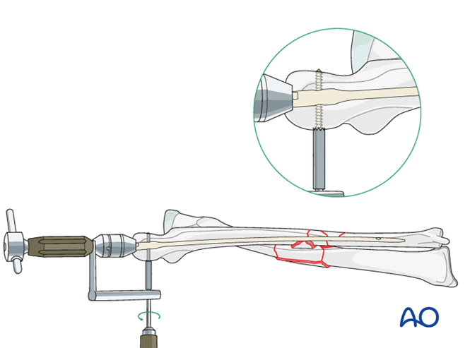 Intramedullary nailing for Multifragmentary, fragmentary segmental ...