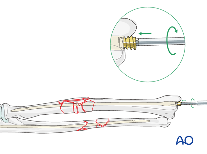 Intramedullary nailing for Multifragmentary, fragmentary segmental ...