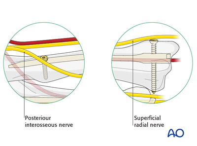 Intramedullary nailing for Multifragmentary, fragmentary segmental ...