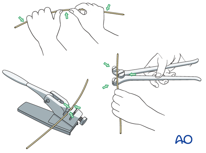 Intramedullary nailing for Multifragmentary, fragmentary segmental ...