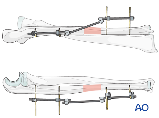 External fixation for Transverse simple fracture of the ulna