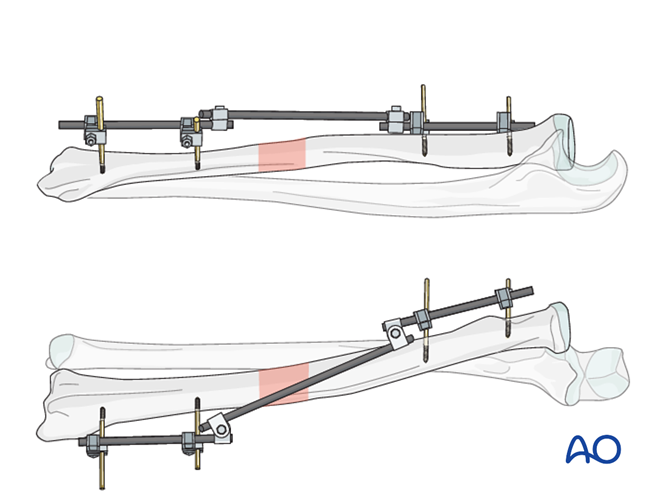 External fixation for Oblique simple fracture of the radius