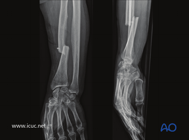 ORIF - Plating for Simple fracture of the radius, with dislocation of ...