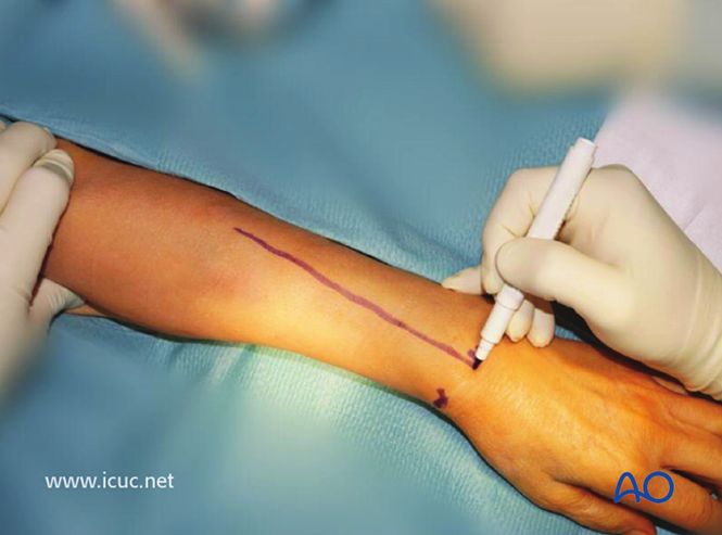 ORIF - Plating for Simple fracture of the radius, with dislocation of ...