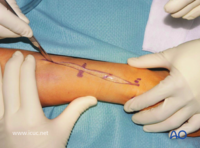 ORIF - Plating for Simple fracture of the radius, with dislocation of ...