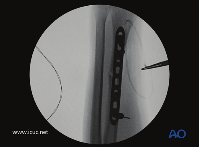 ORIF - Plating for Simple fracture of the radius, with dislocation of ...