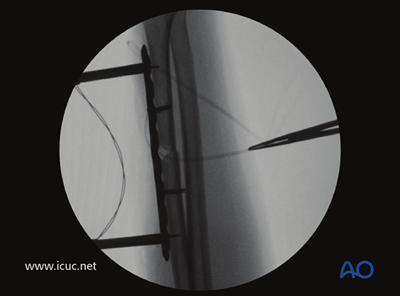 ORIF - Plating for Simple fracture of the radius, with dislocation of ...