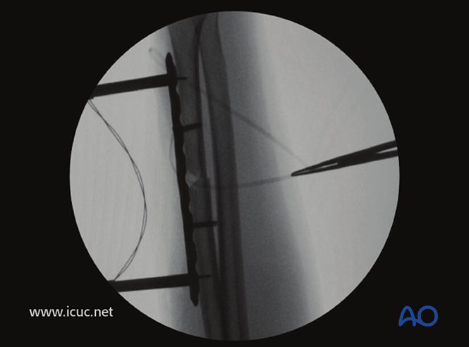 ORIF - Plating for Simple fracture of the radius, with dislocation of ...