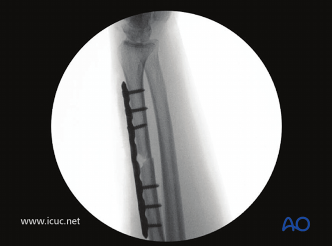 ORIF - Plating for Simple fracture of the radius, with dislocation of ...