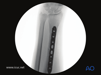 ORIF - Plating for Simple fracture of the radius, with dislocation of ...