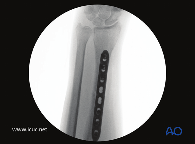 ORIF - Plating for Simple fracture of the radius, with dislocation of ...