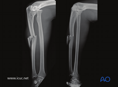 ORIF - Plating for Simple fracture of the ulna, with dislocation of ...