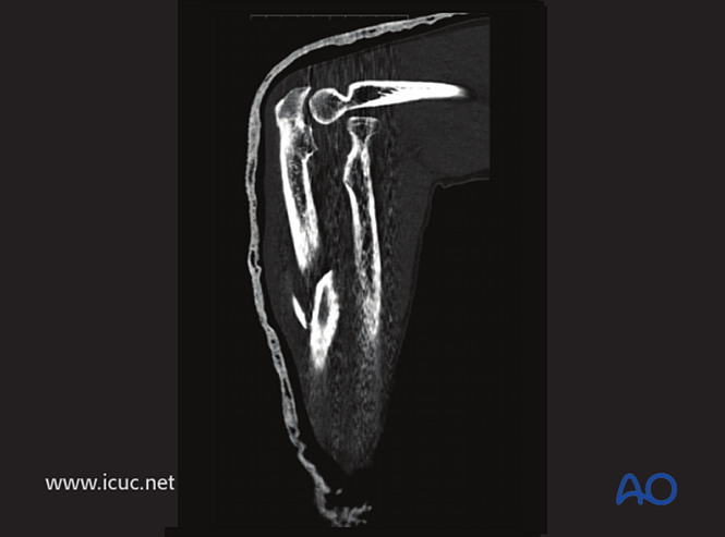 ORIF - Plating for Simple fracture of the ulna, with dislocation of ...