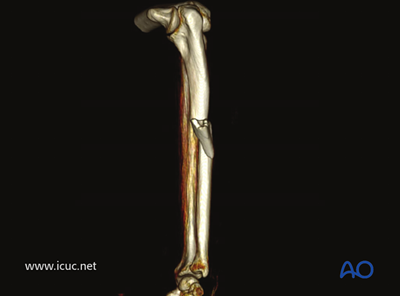 ORIF - Plating for Simple fracture of the ulna, with dislocation of ...