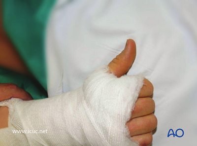 ORIF - Plating for Simple fracture of the ulna, with dislocation of ...