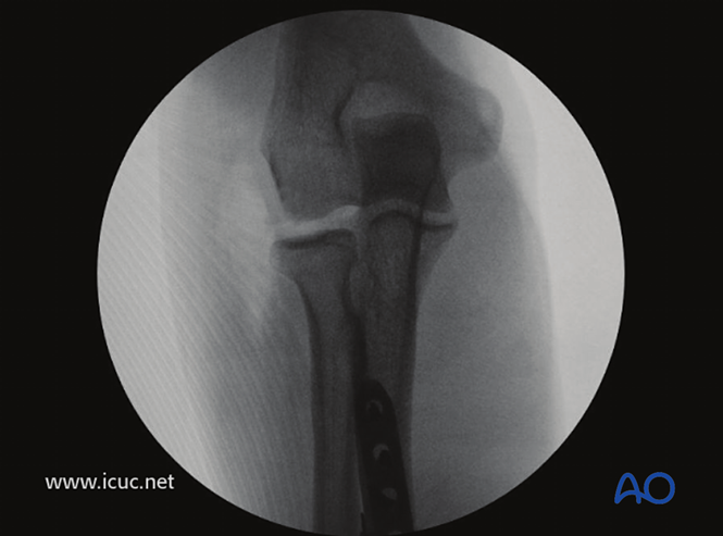 ORIF - Plating for Simple fracture of the ulna, with dislocation of ...