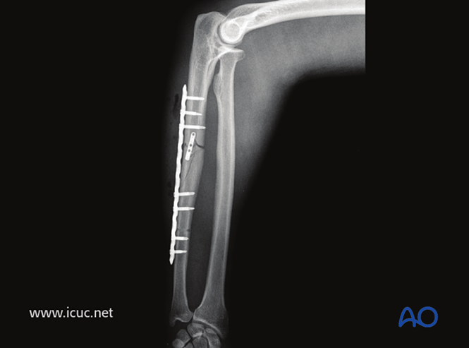 ORIF - Plating for Simple fracture of the ulna, with dislocation of ...